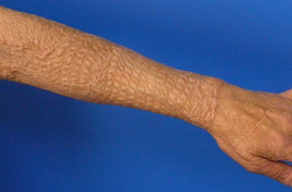 Cómo tratar quemaduras II | Hospital Universitario de Getafe